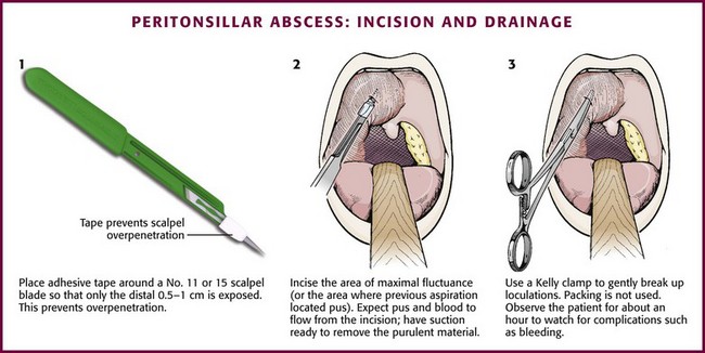 Peritonsillar Abscess 1 – ER Dispo